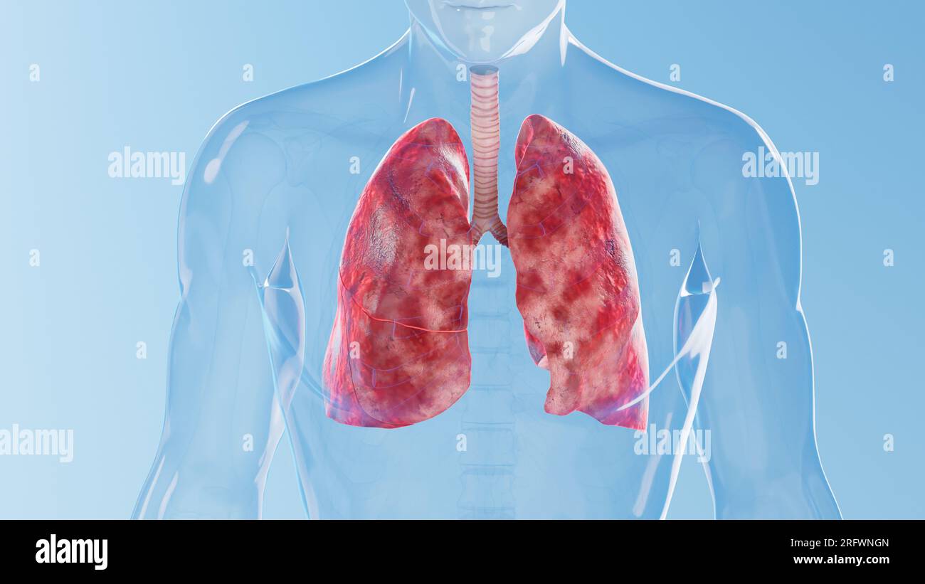 Inflamed lungs hi-res stock photography and images - Alamy