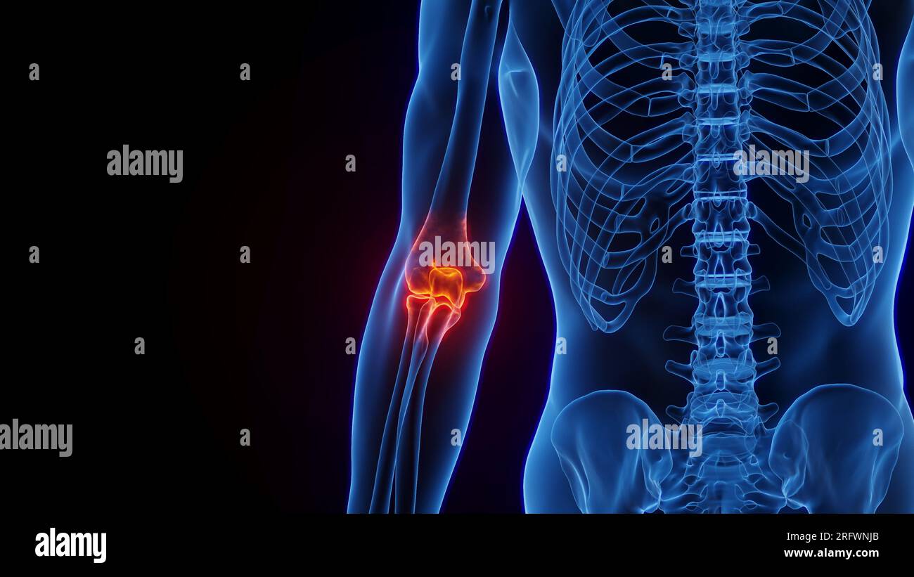 Elbow bursitis illustration hi-res stock photography and images - Alamy