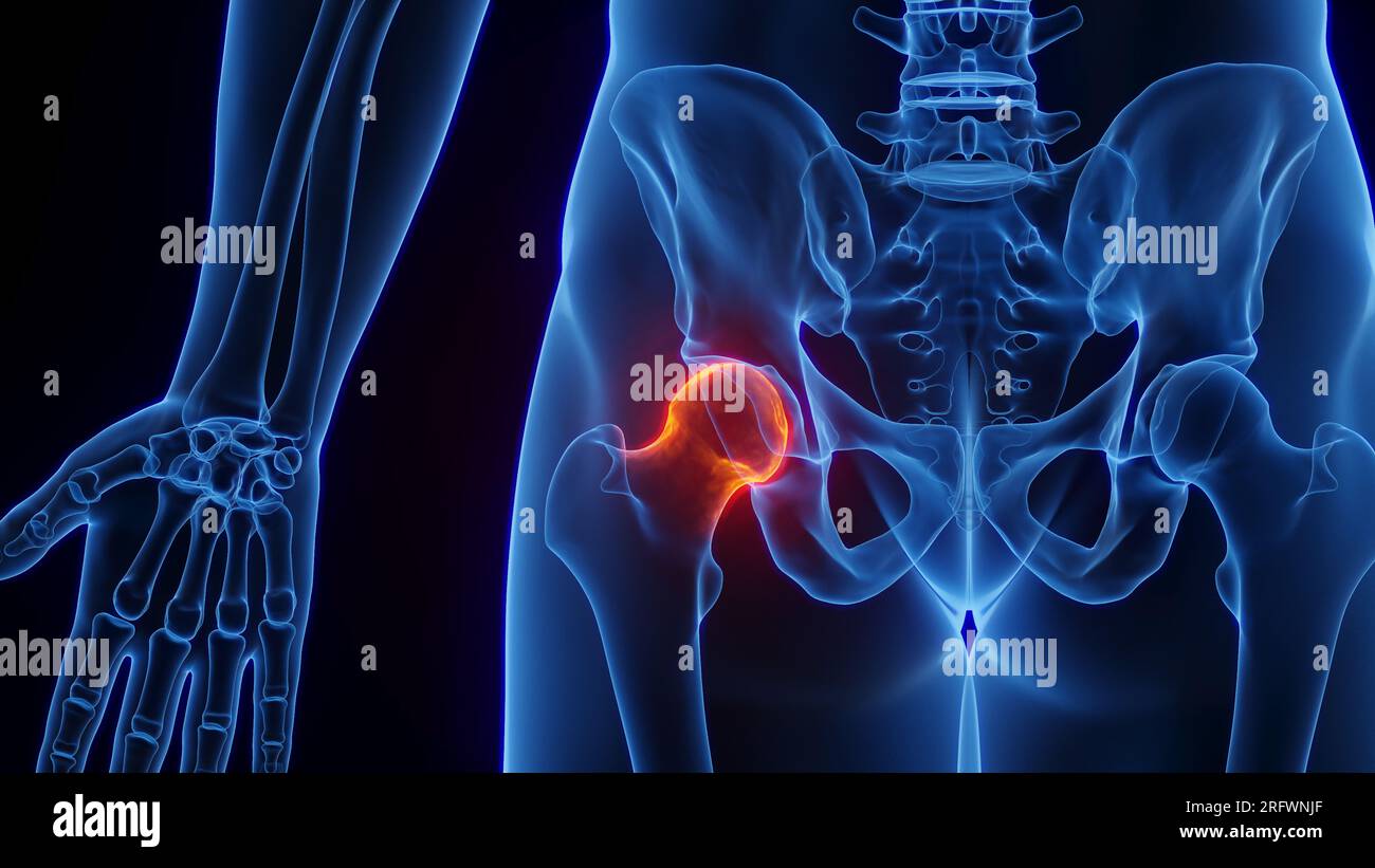 Inflamed hip joint, illustration Stock Photo - Alamy