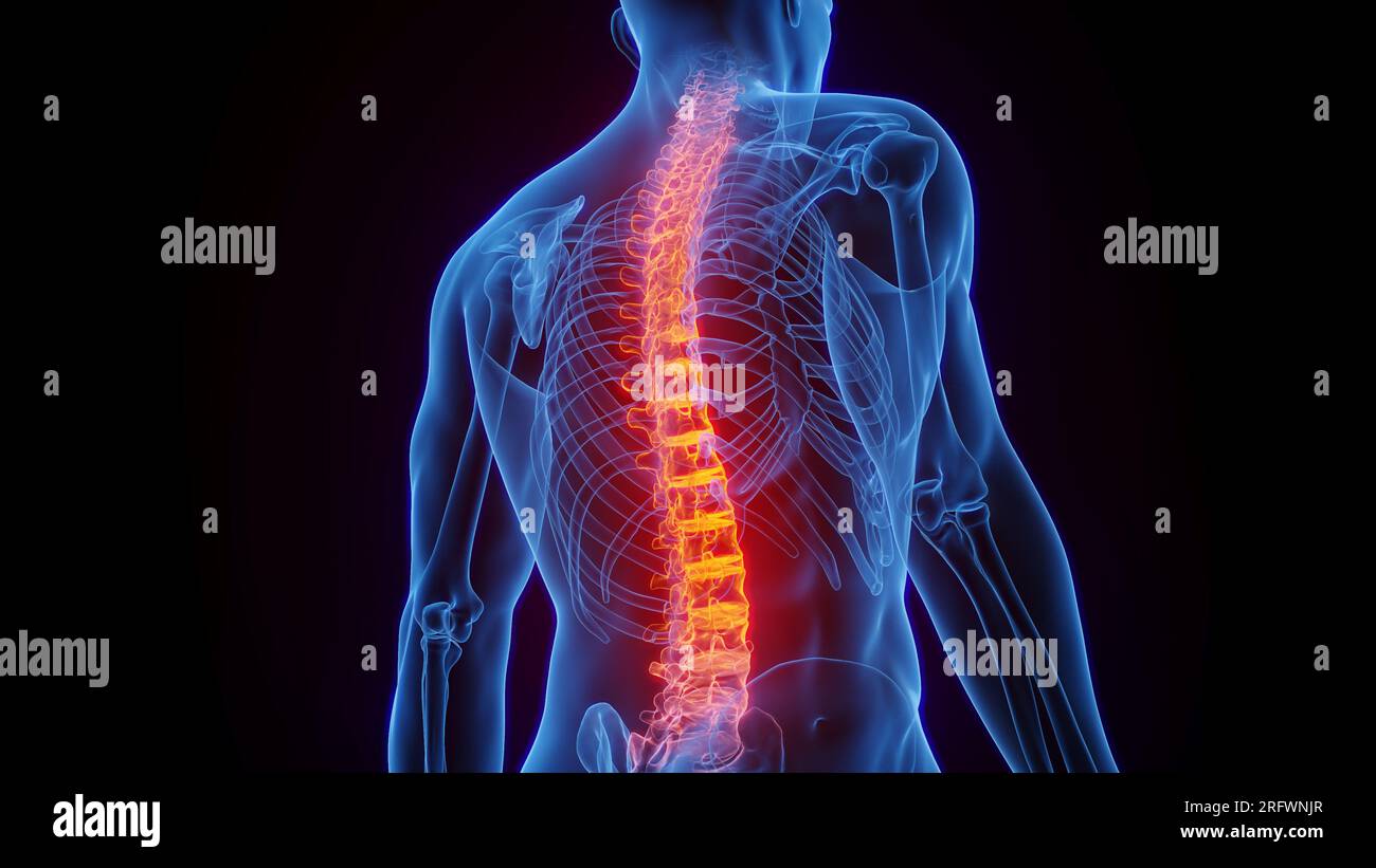 Inflamed spine, illustration Stock Photo - Alamy