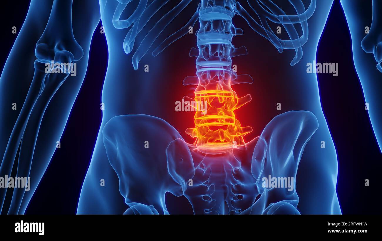 Inflamed lumbar spine, illustration Stock Photo - Alamy
