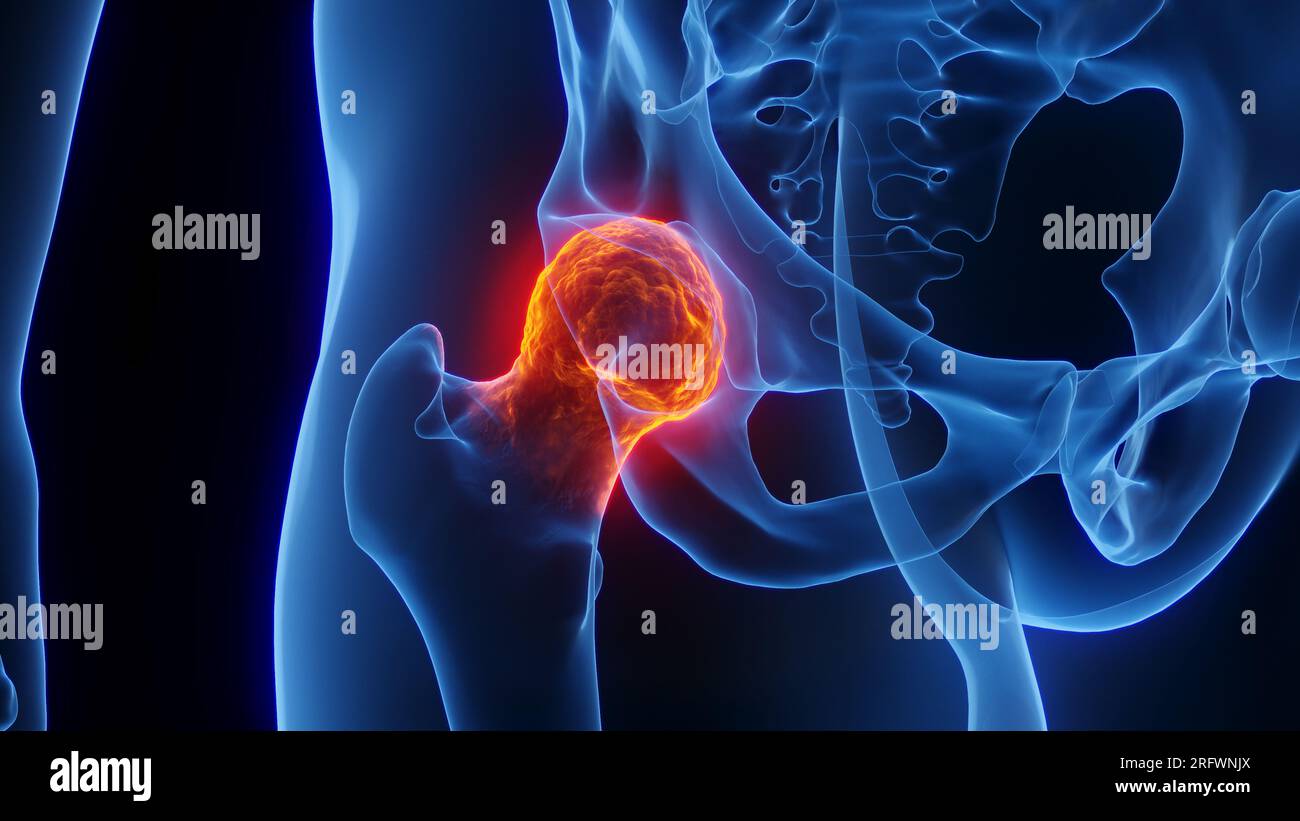 Inflamed hip joint, illustration Stock Photo - Alamy