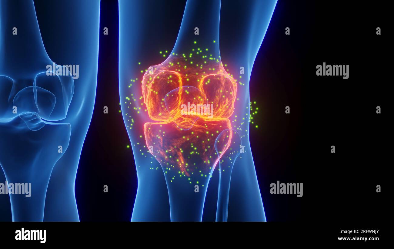 Inflamed knee healing, illustration Stock Photo - Alamy