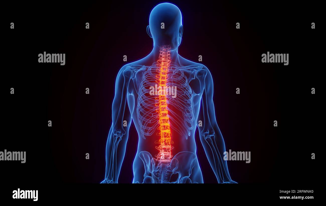 Inflamed spinal joints hi-res stock photography and images - Alamy