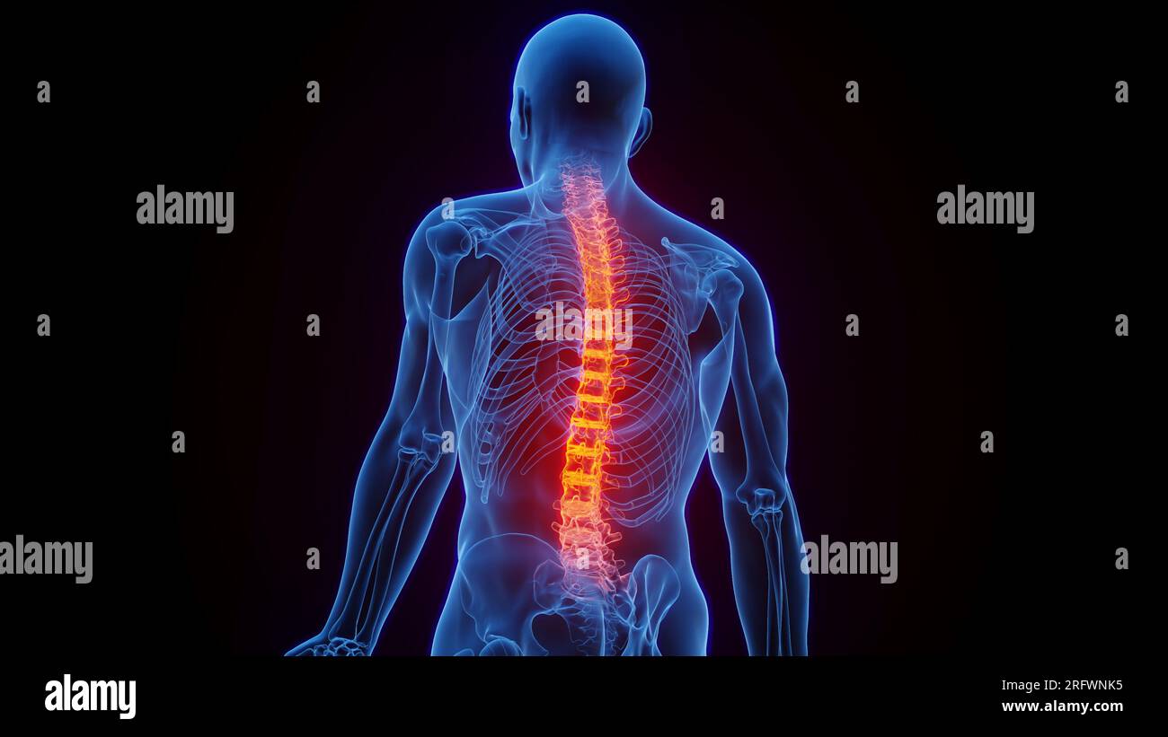 Inflamed spinal joint hi-res stock photography and images - Alamy