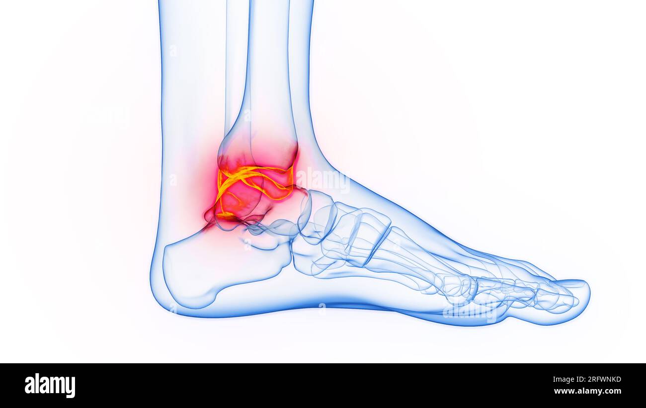 Inflamed joints Cut Out Stock Images & Pictures - Alamy