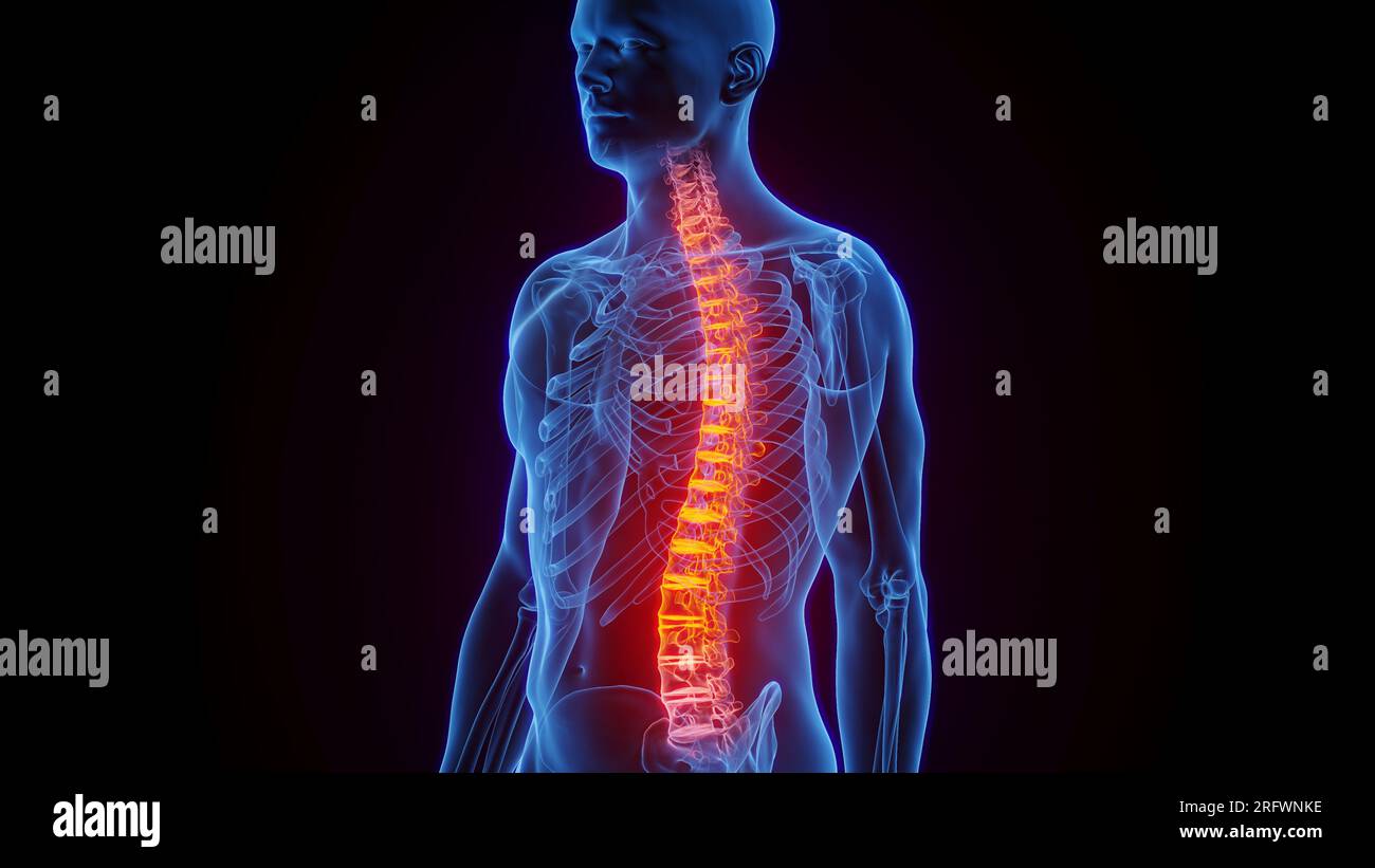 Inflamed spinal joints hi-res stock photography and images - Alamy