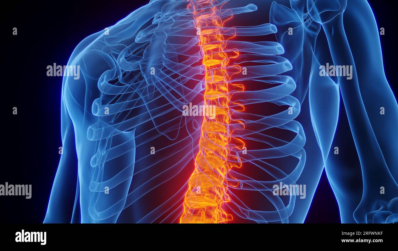 Inflamed spine, illustration Stock Photo - Alamy