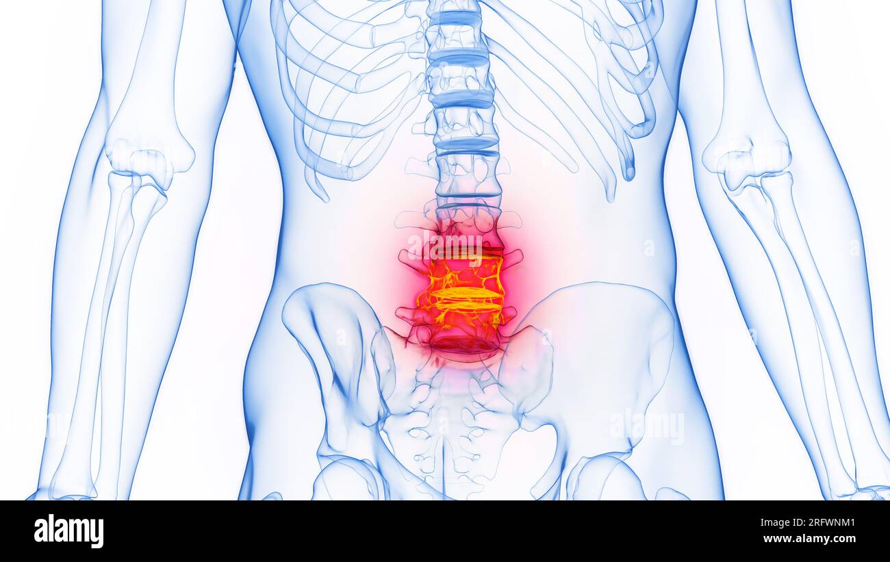 Inflamed lumbar spine, illustration Stock Photo - Alamy