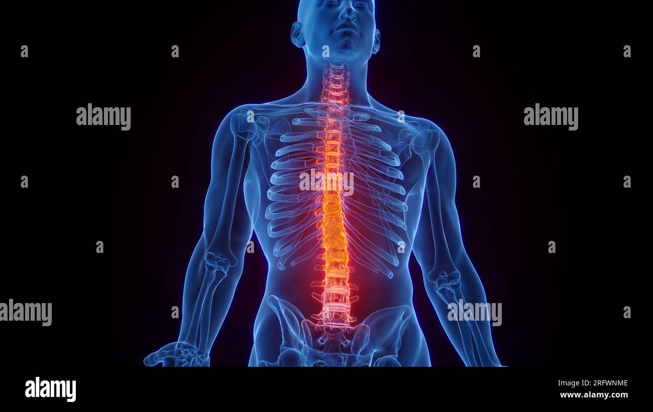 Inflamed spine, illustration Stock Photo - Alamy