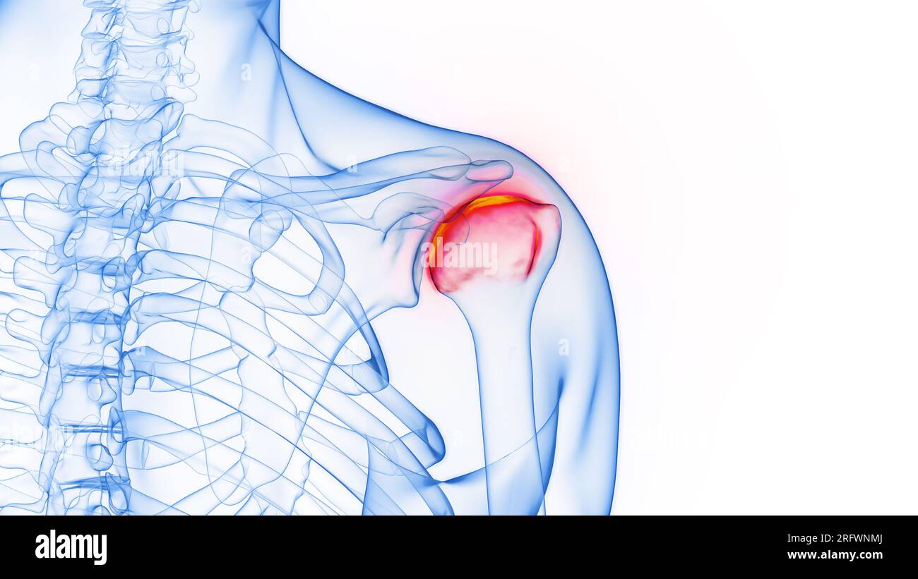 Shoulder enthesitis hi-res stock photography and images - Alamy