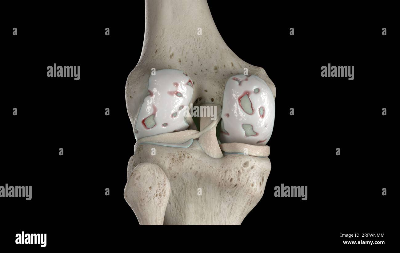 Damaged knee cartilage, illustration Stock Photo - Alamy