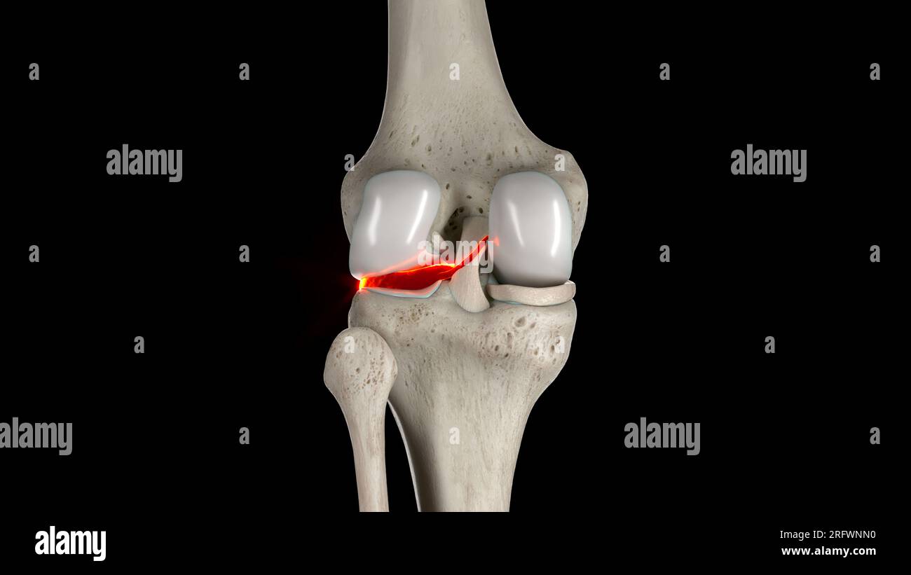 Lateral meniscus hi-res stock photography and images - Alamy
