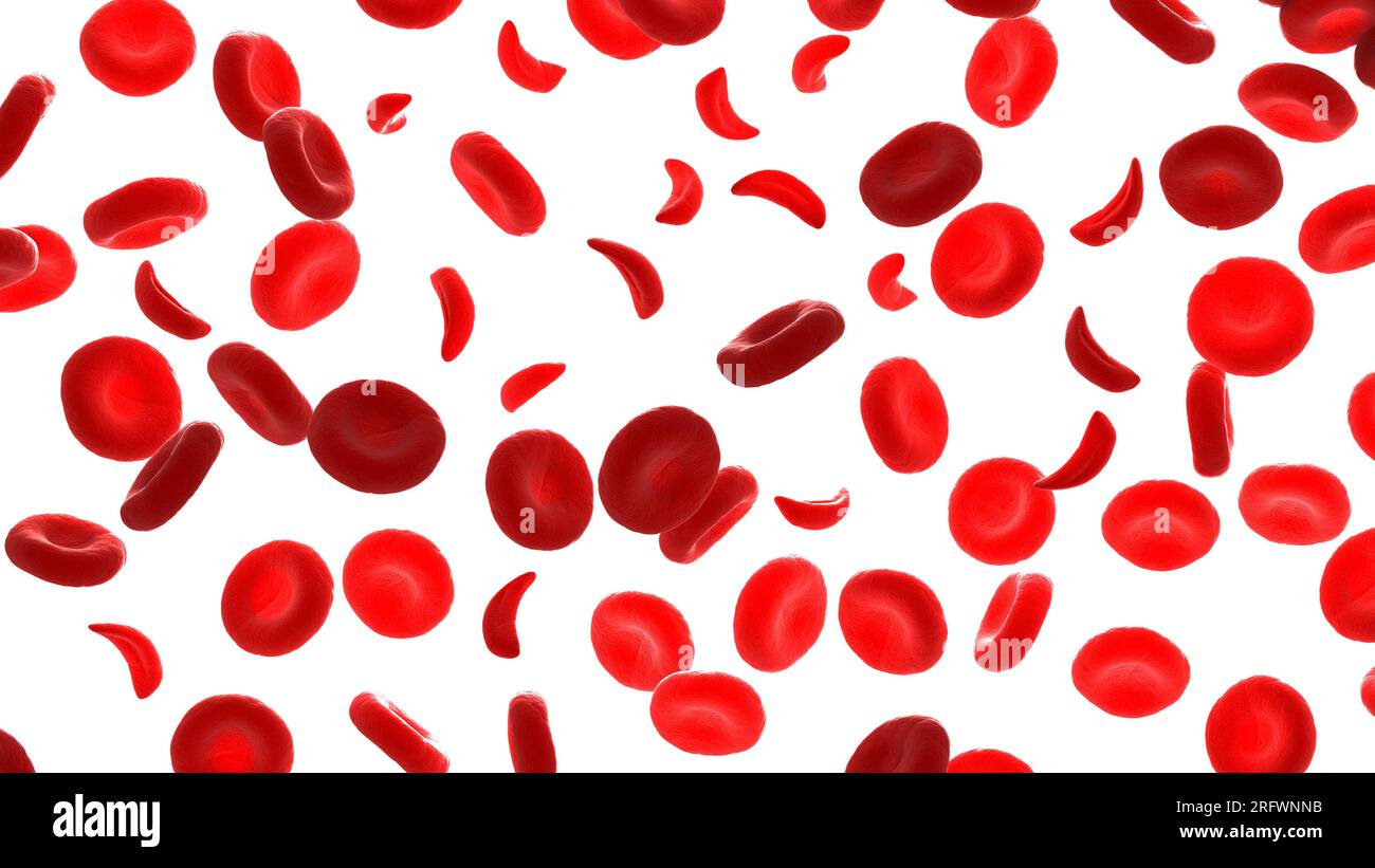 Sickle cells, illustration Stock Photo - Alamy