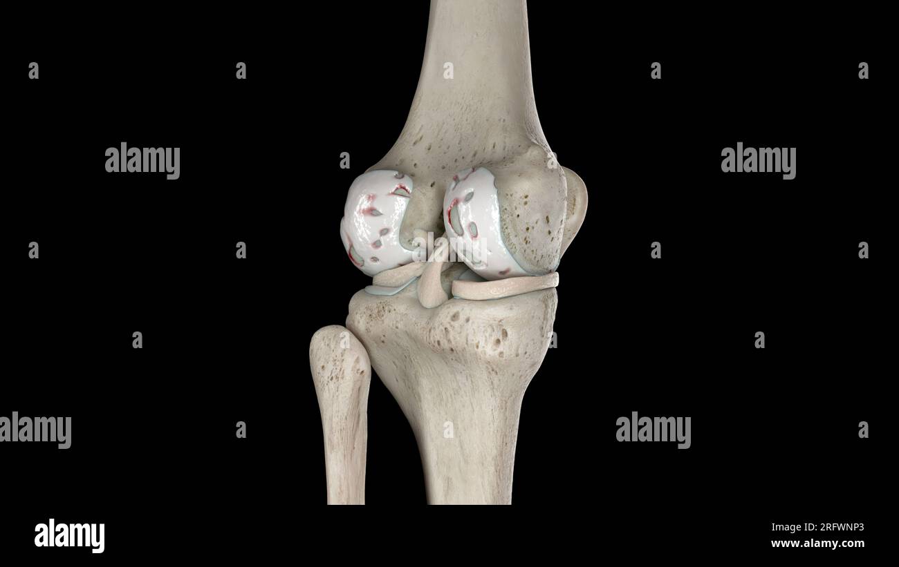 Damaged knee cartilage, illustration Stock Photo - Alamy