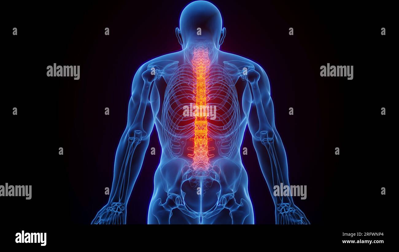 Inflamed spine, illustration Stock Photo - Alamy