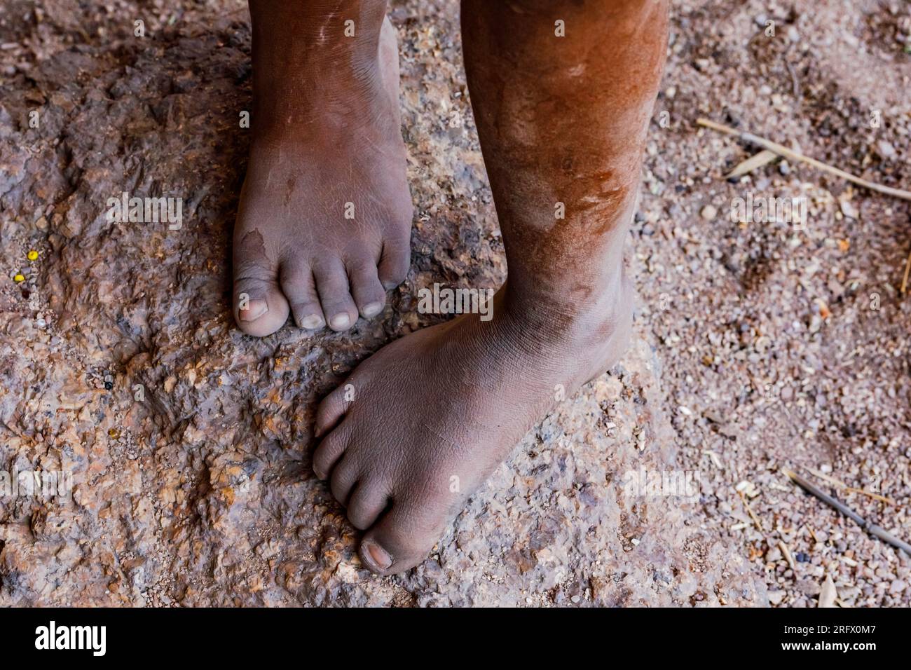 Dark skinned feet of a boy among the bushmen in Namibia, Africa Stock ...