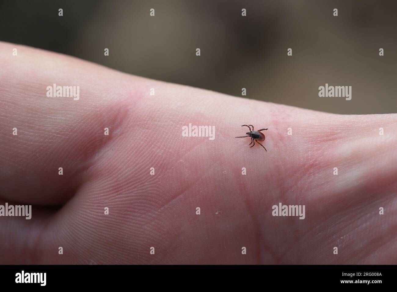 A tick walking on the hand. It is a dangerous arachnid that is a vector ...