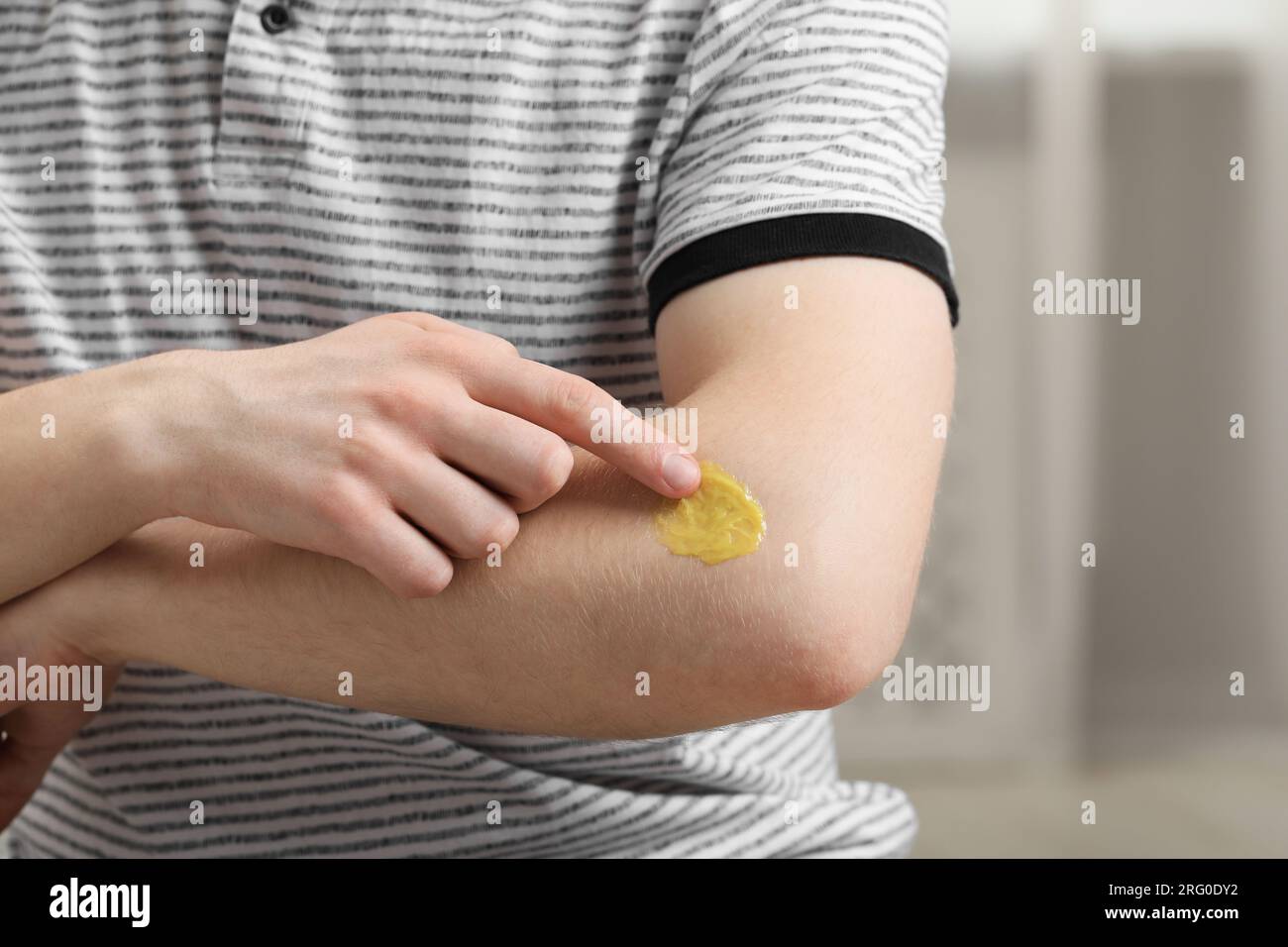 Man applying ointment onto hi-res stock photography and images - Alamy