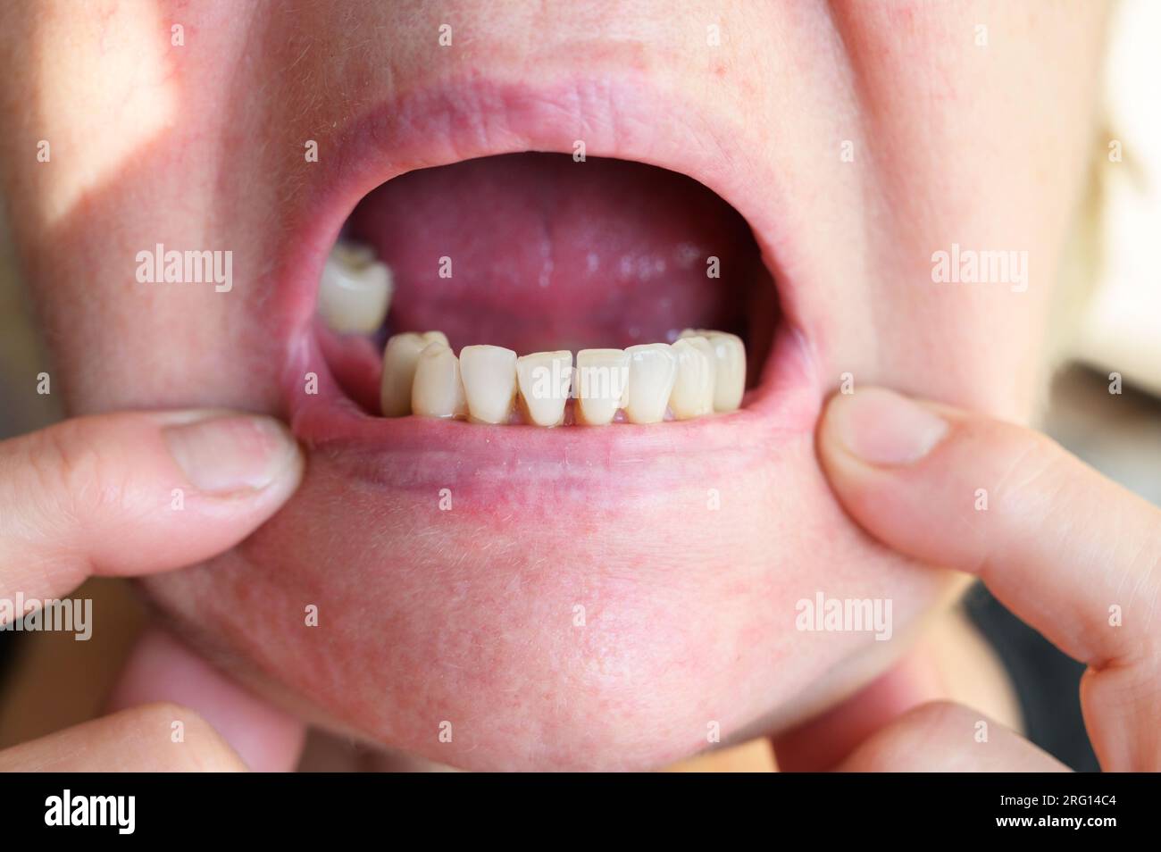 Close-up photo of natural looking teeth of a aged woman Stock Photo - Alamy