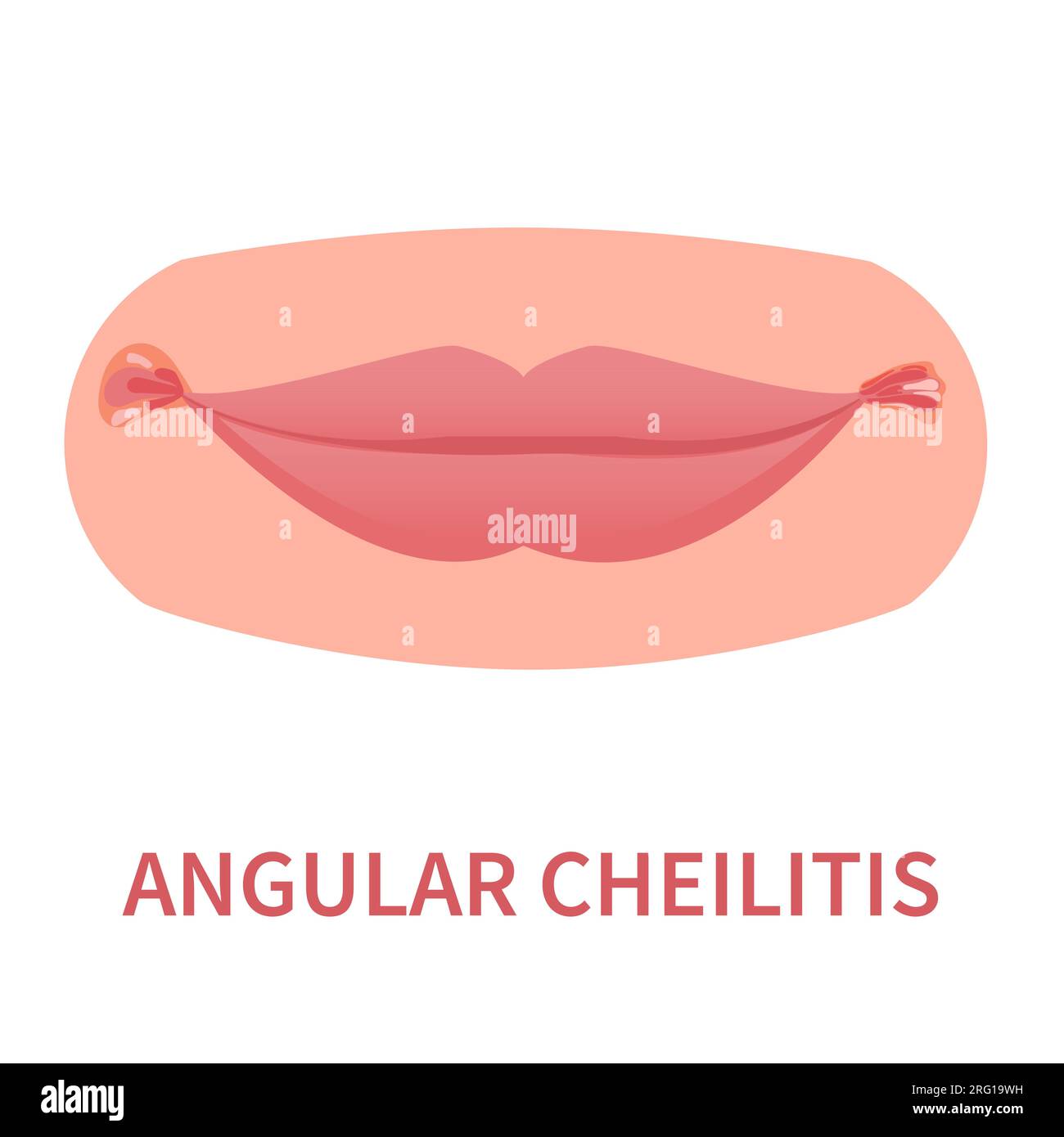 Angular Cheilitis Vs Cold Sore Home Remedies For Angular Cheilitis ...