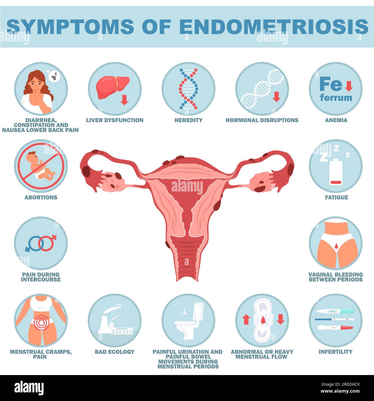 Symptom of endometriosis reproductive disease vector illustration Stock Vector Image & Art - Alamy