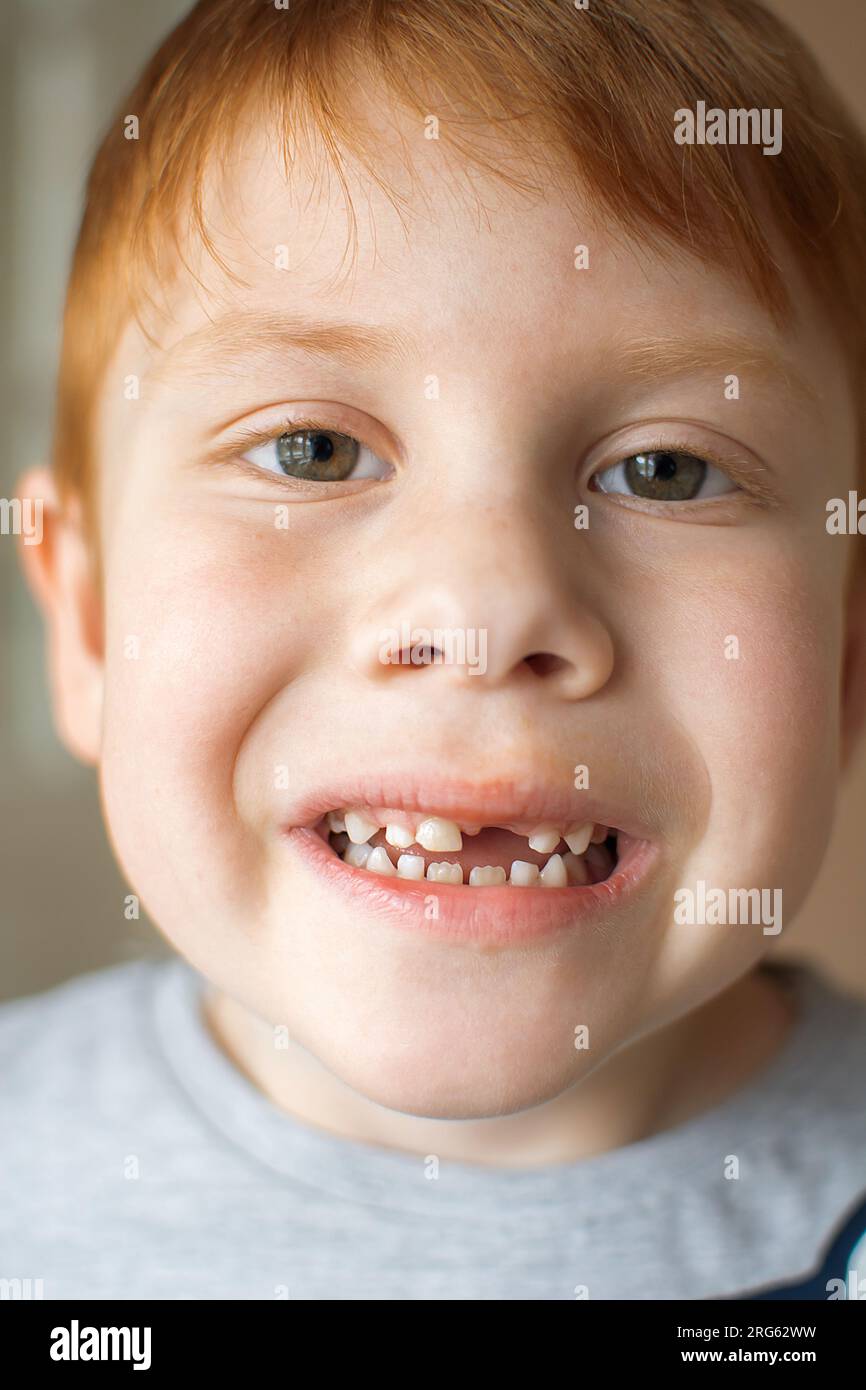 Portrait of a red-haired six-year-old boy without a front tooth. A child's smile without an ...