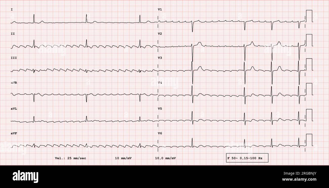 Ventricular Flutter Ecg