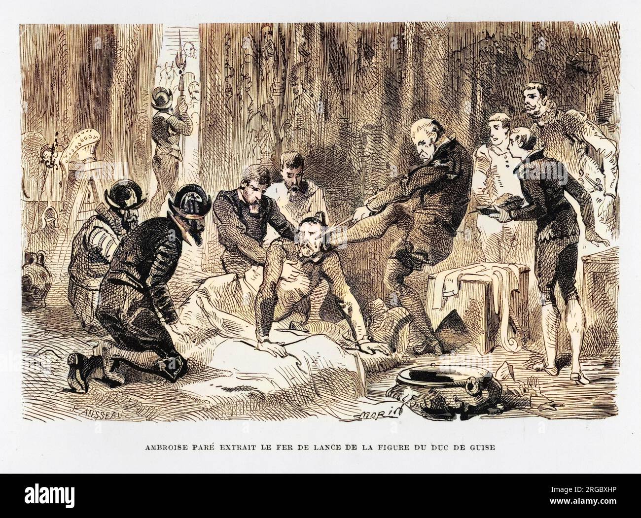 Ambroise Pare, French surgeon, (1510-1590) Pare removes a lance head ...