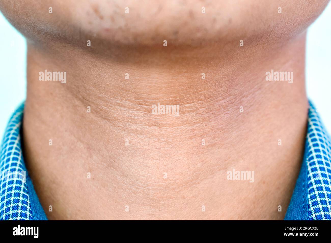 Aging skin folds or creases or wrinkles at neck of Southeast Asian ...
