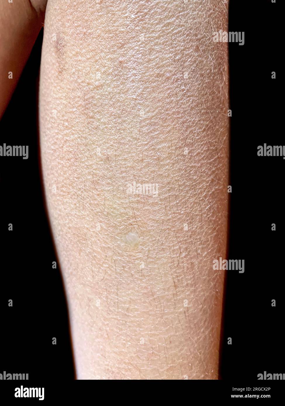 Dry skin at leg of Asian boy in cold season. Isolated on black Stock ...