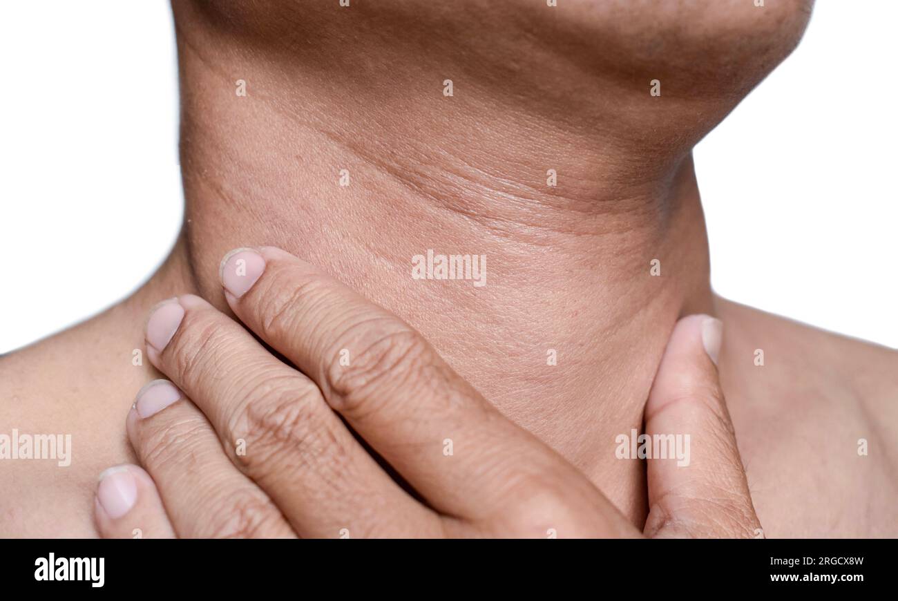 Aging skin folds or creases or wrinkles at neck of Southeast Asian ...