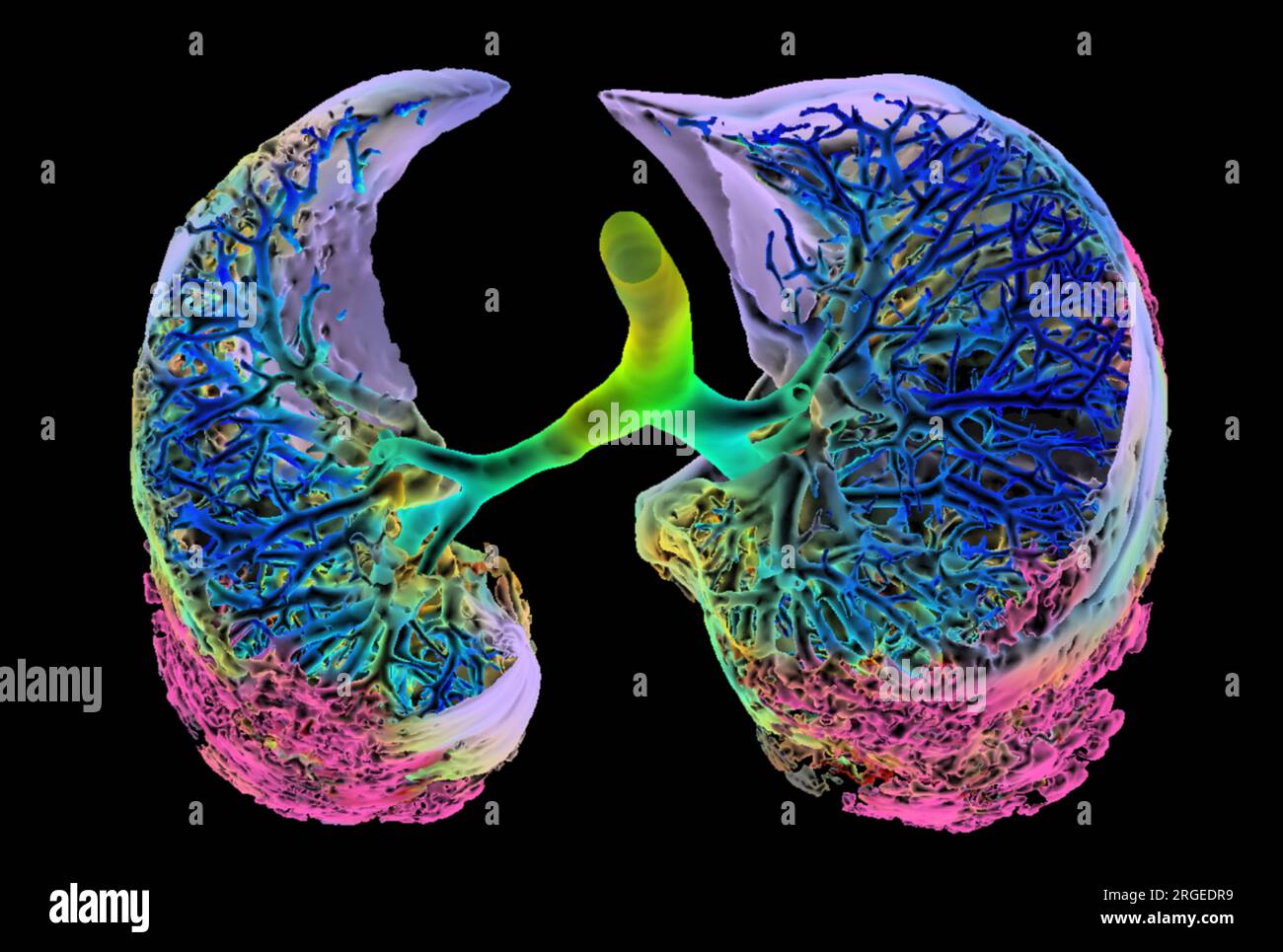 Interstitial lung disease, 3D CT scan Stock Photo - Alamy