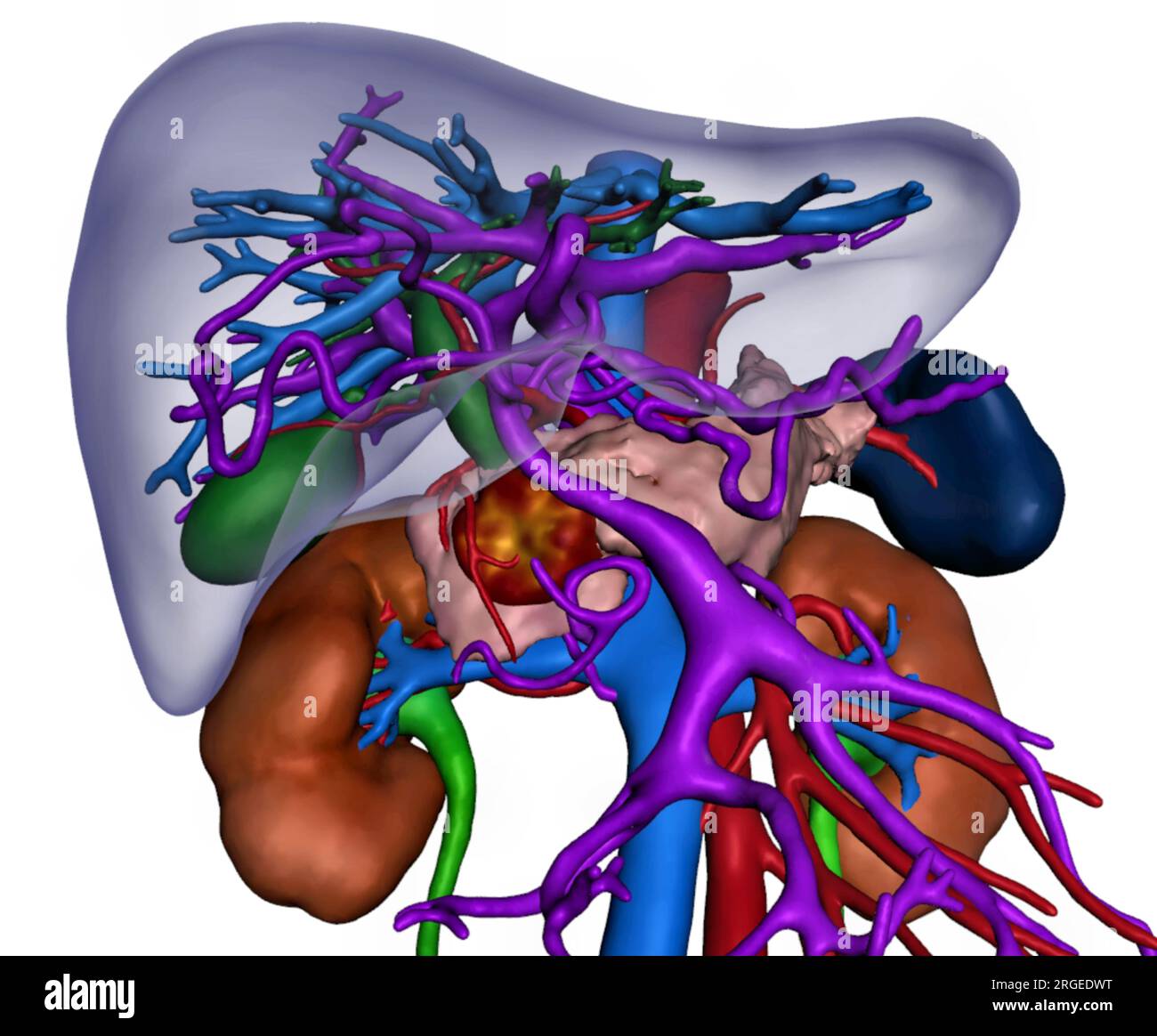 Pancreatic cancer, 3D CT scan Stock Photo - Alamy