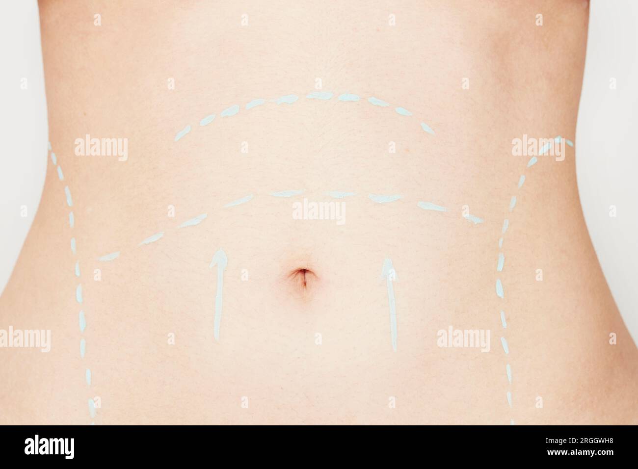 Abdomen of young woman with drawn lines Stock Photo - Alamy