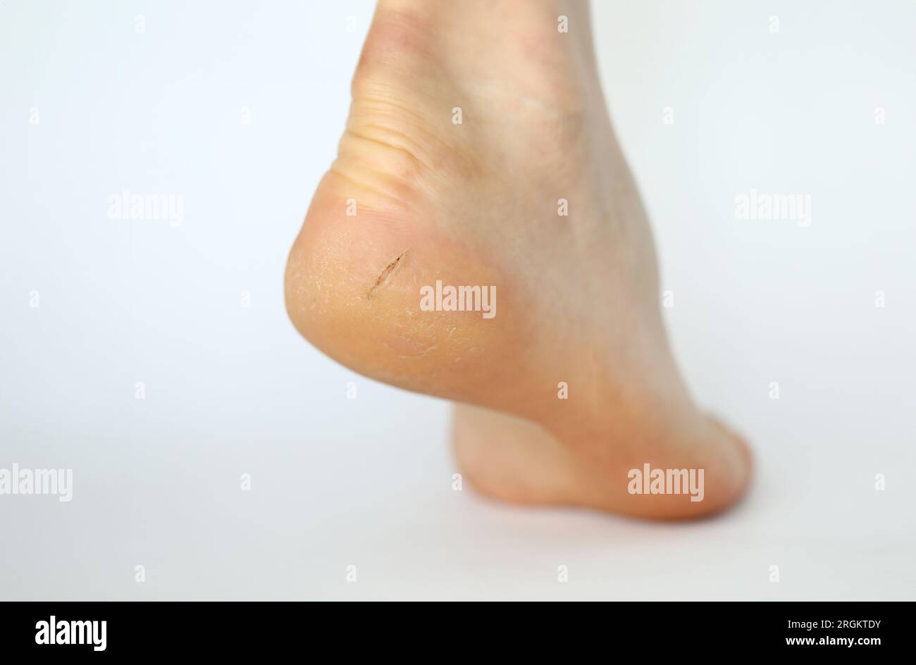 Dry leg covered with painful callous cracks Stock Photo - Alamy