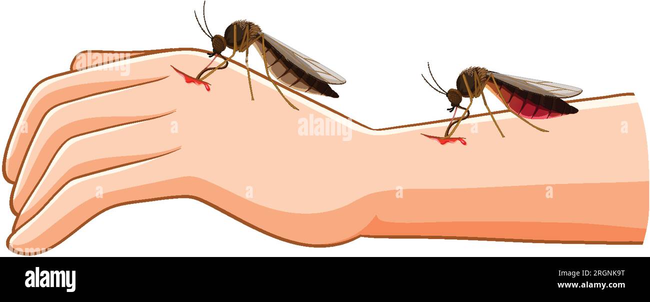 Vector cartoon illustration of a mosquito biting a human arm and ...
