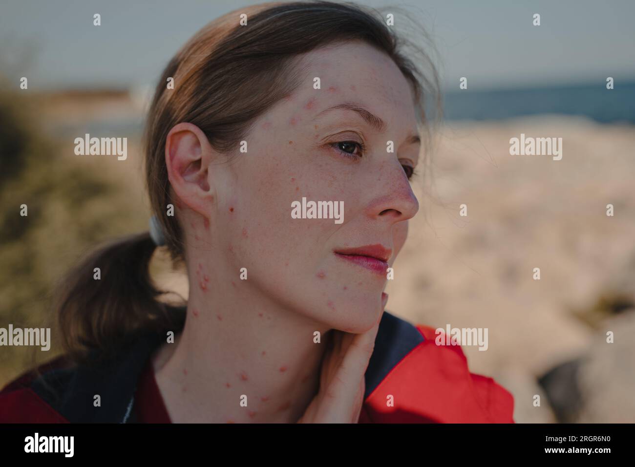 Chicken pox virus hi-res stock photography and images - Alamy