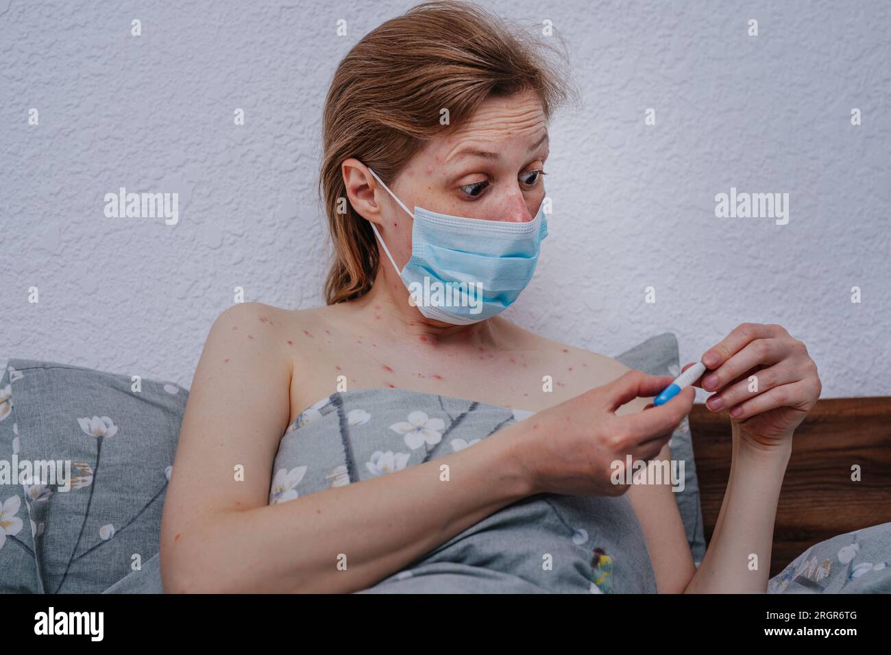 Chickenpox rash hi-res stock photography and images - Alamy