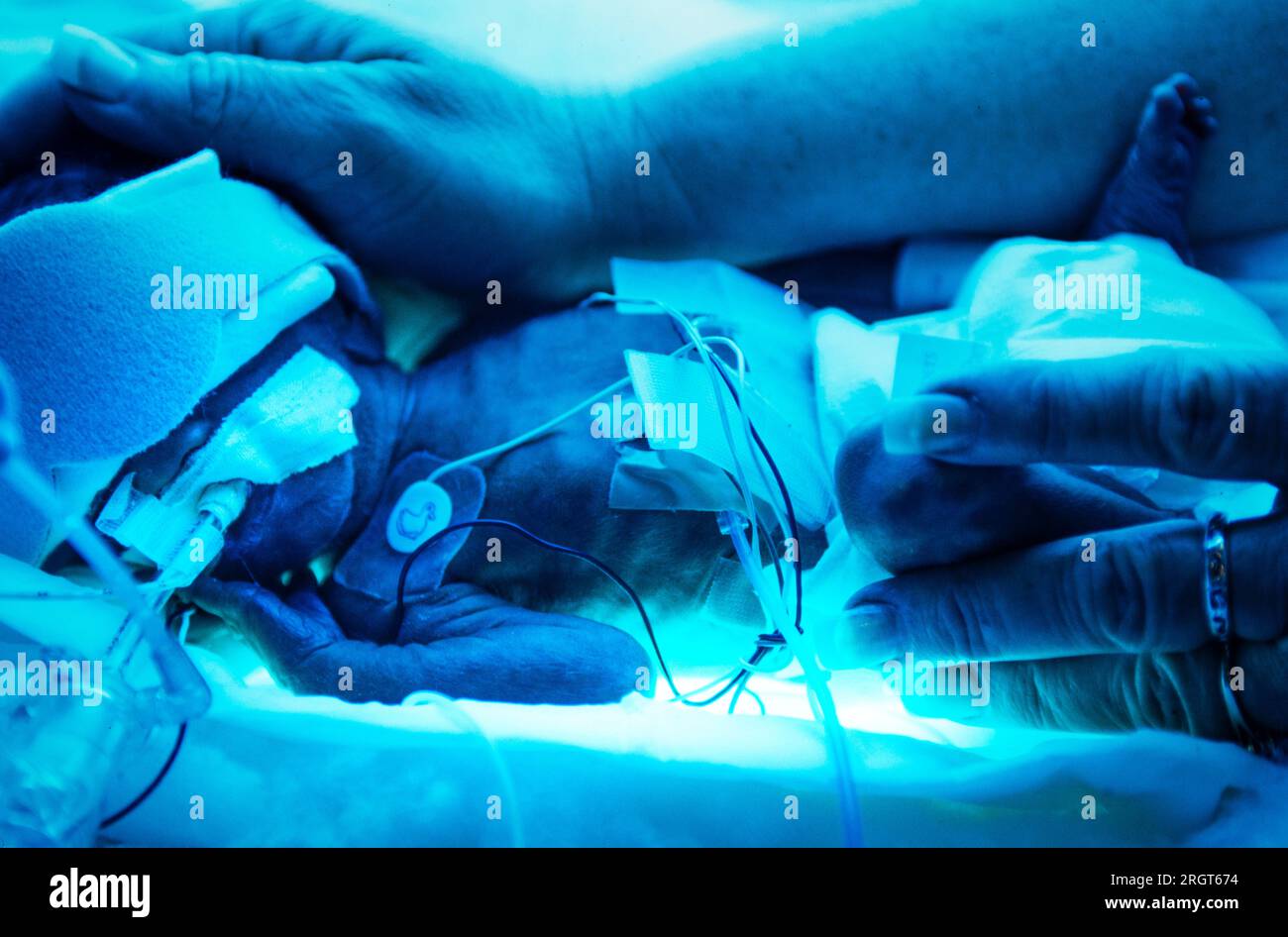 A neonatal intensive care hospital doctor monitors a tiny premature ...