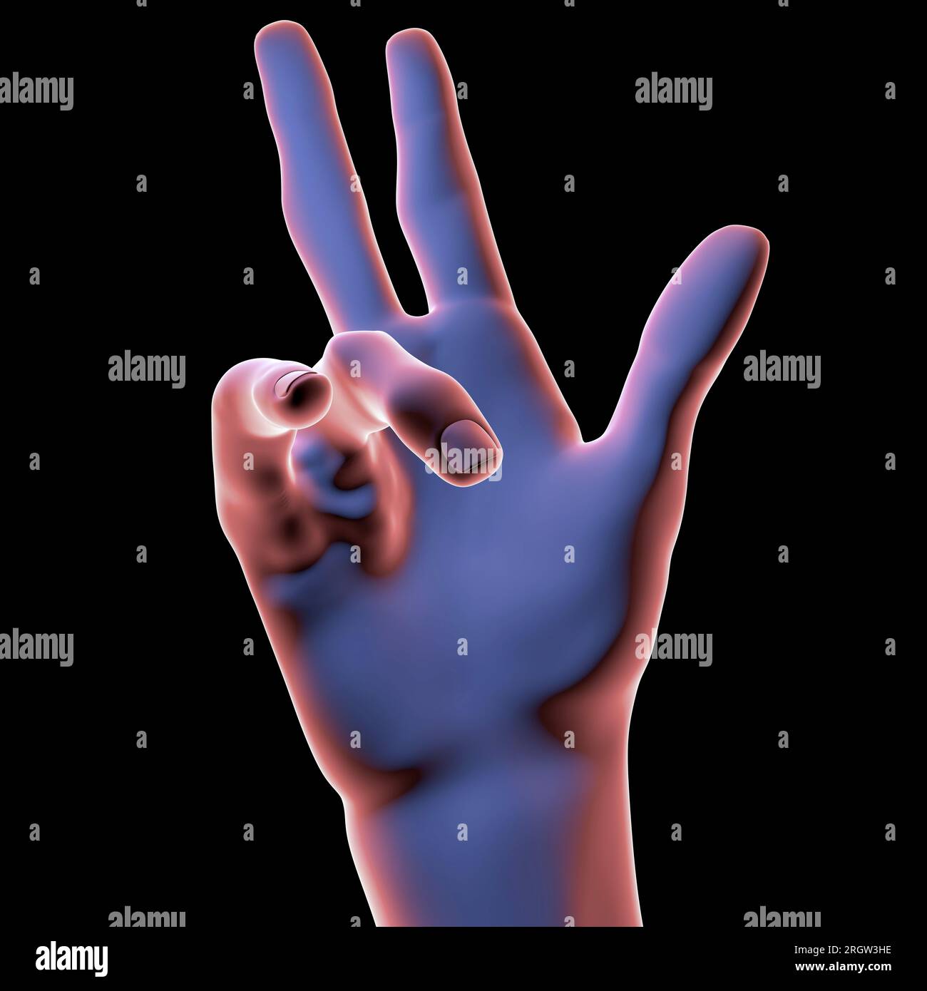 Dupuytren's contracture, illustration Stock Photo - Alamy