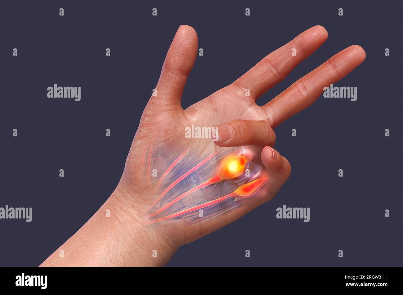 Pdf Intraoperative Manipulation For Flexion Contracture