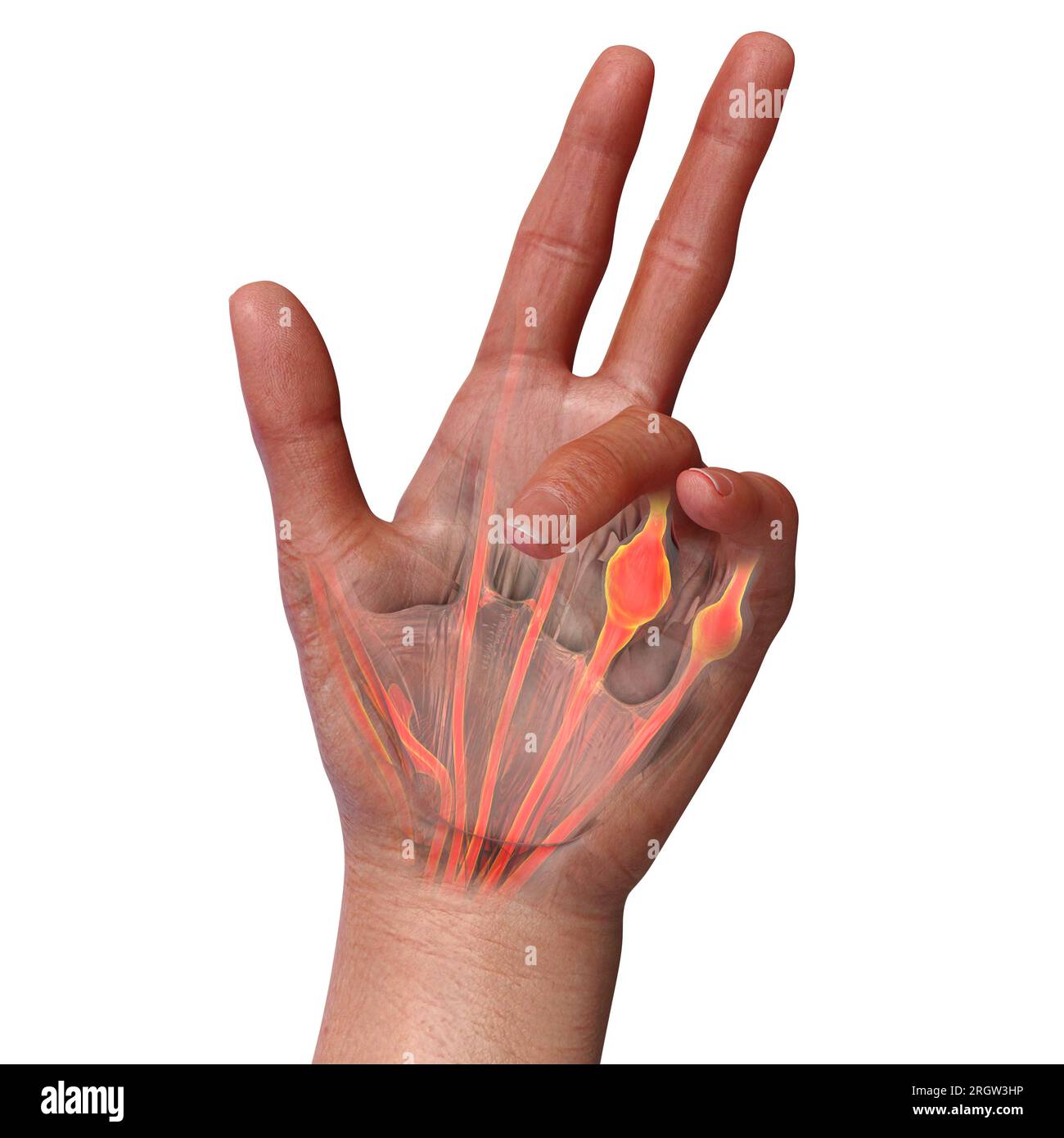 Dupuytren's contracture, illustration Stock Photo - Alamy