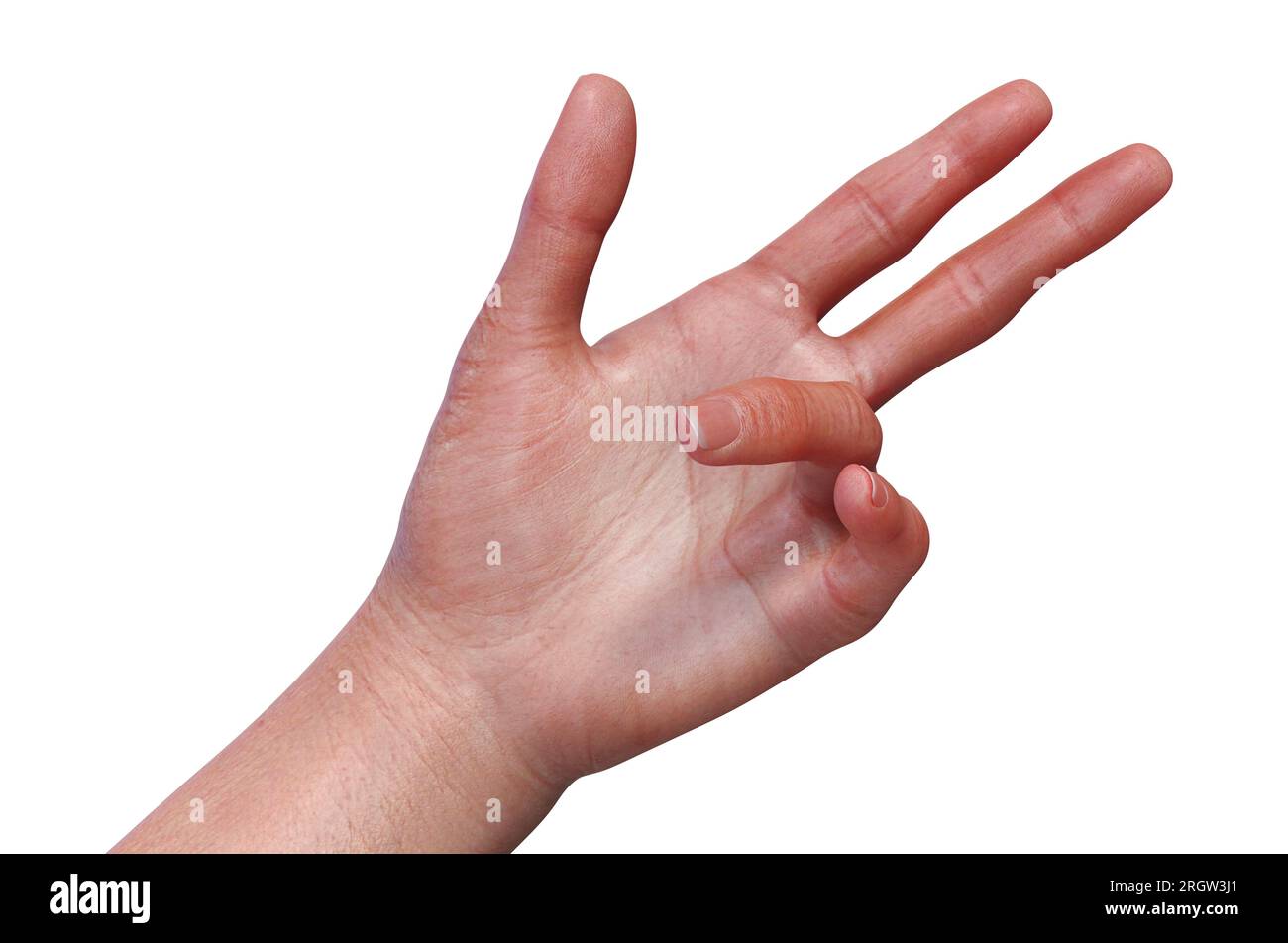 Dupuytren's contracture, illustration Stock Photo - Alamy