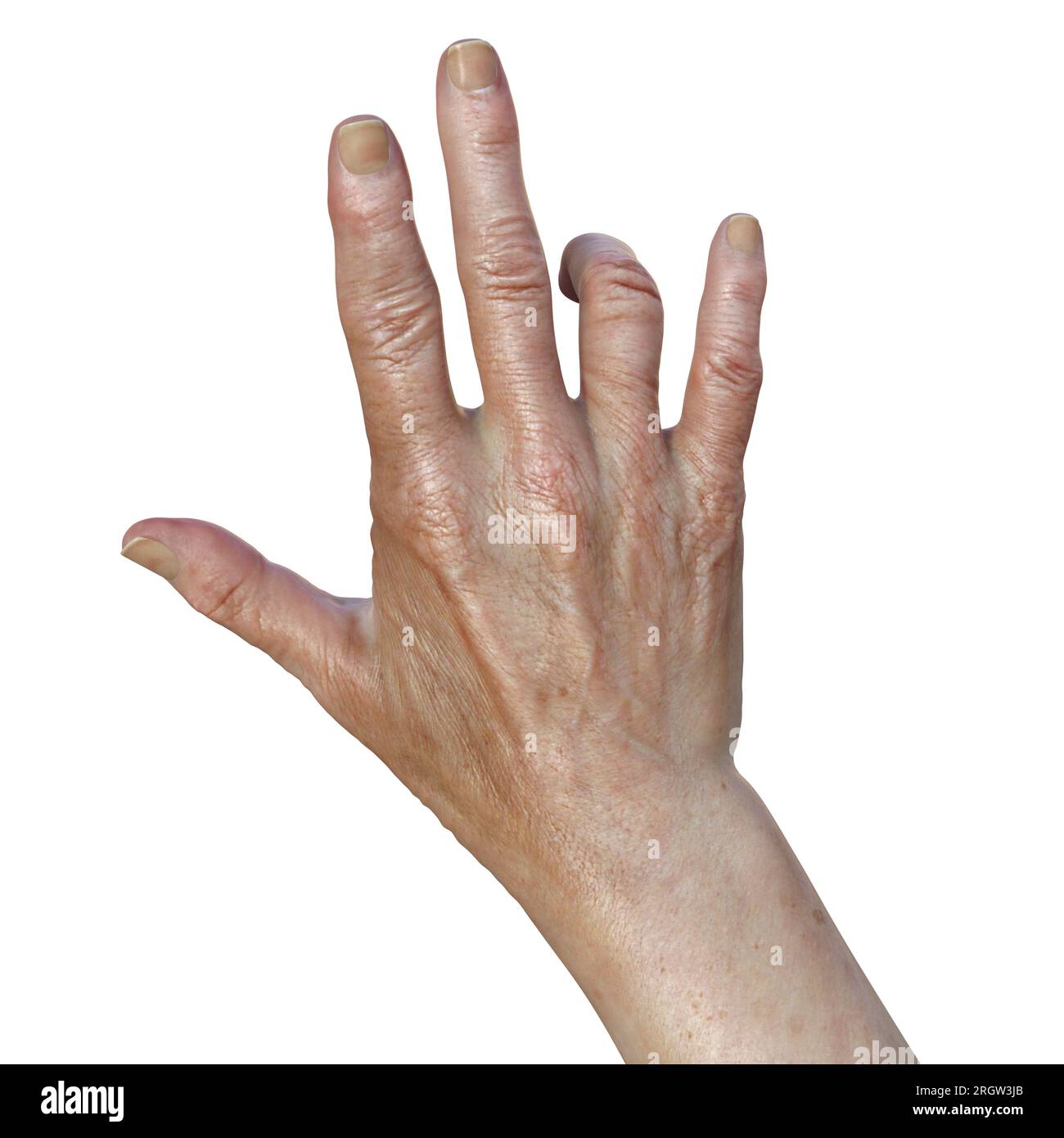 Dupuytren's contracture, illustration Stock Photo - Alamy