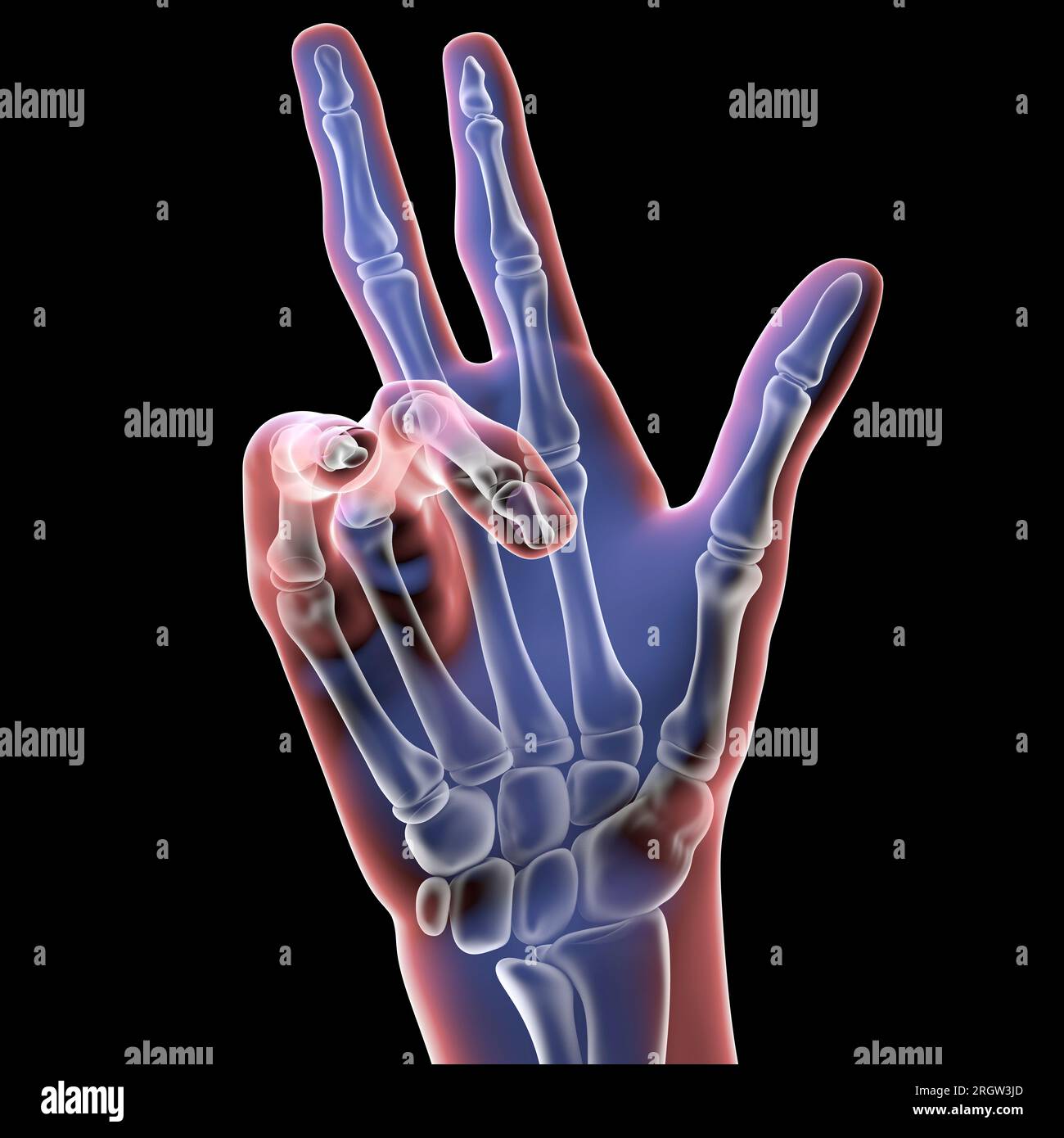 Dupuytren's contracture, illustration Stock Photo - Alamy