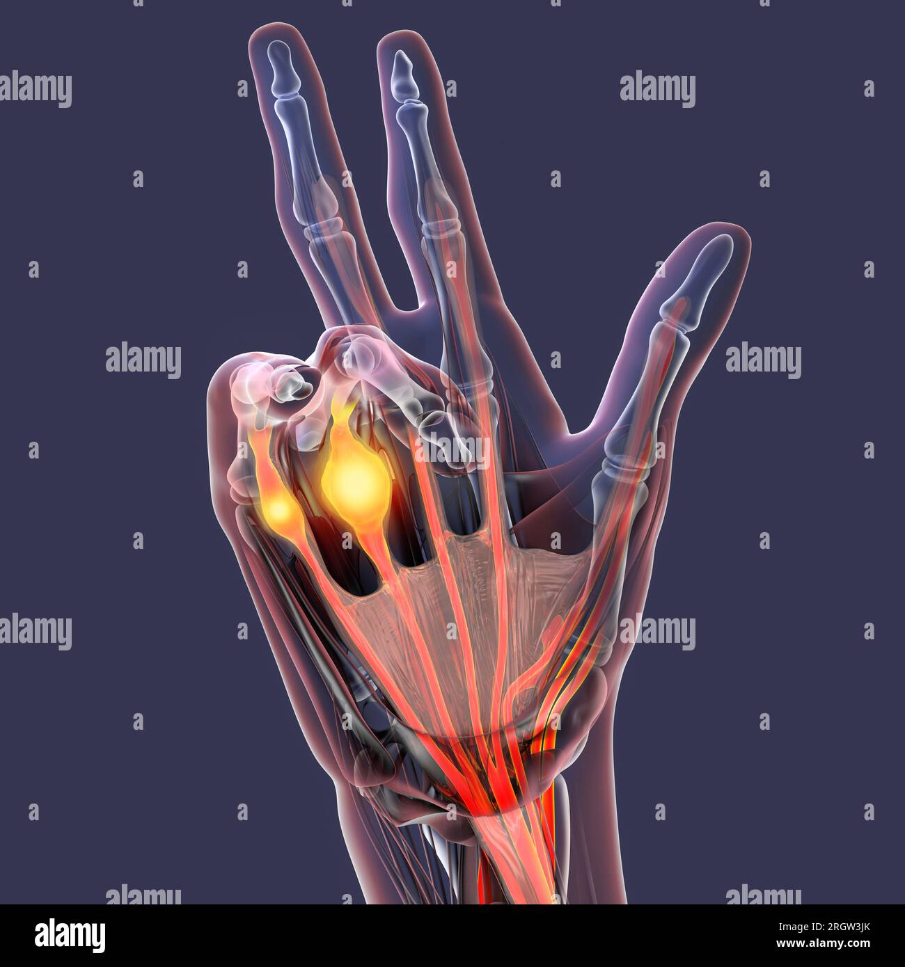 Contracture of hand hi-res stock photography and images - Alamy