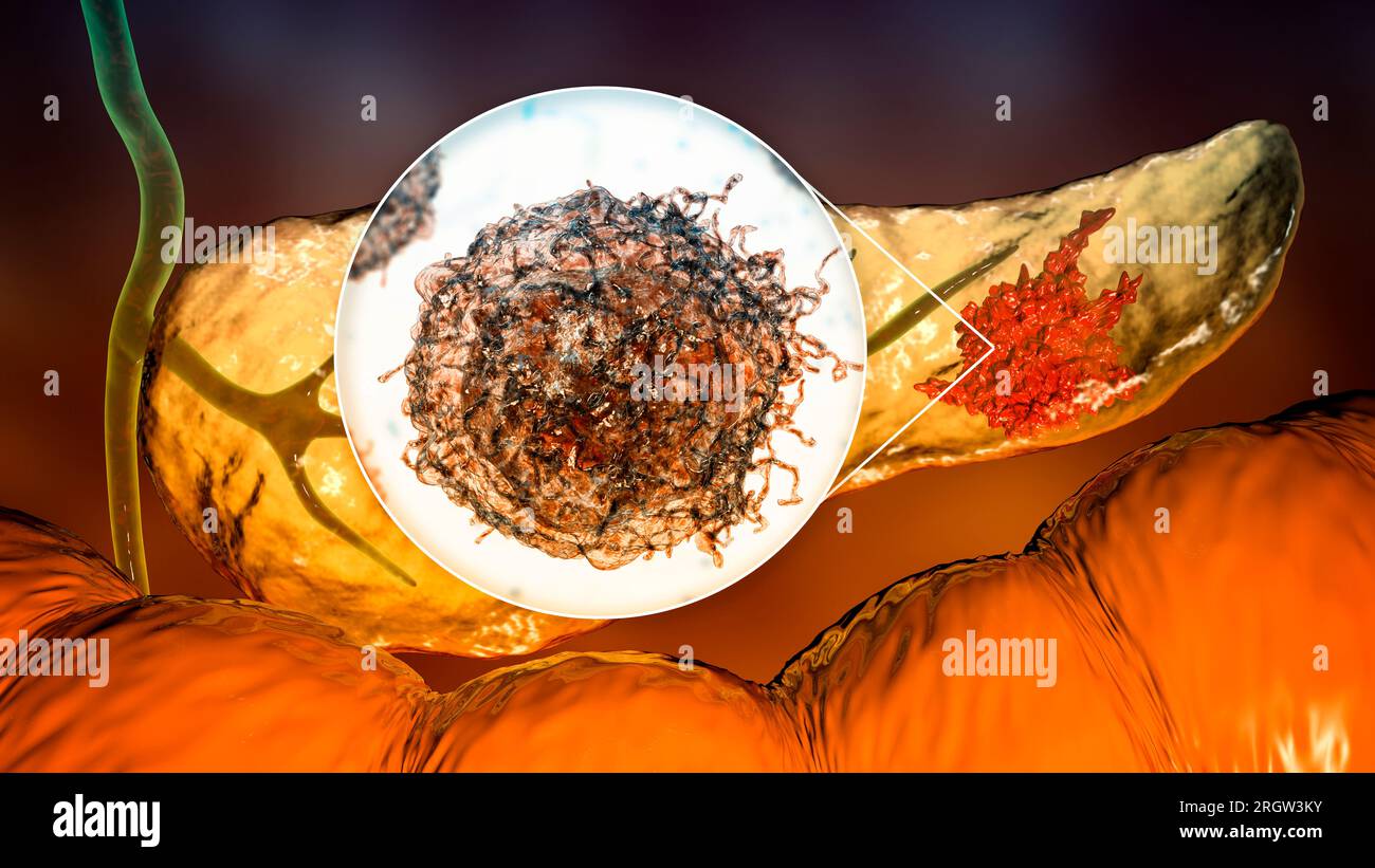 Pancreas pancreatic cancer organs hi-res stock photography and images ...