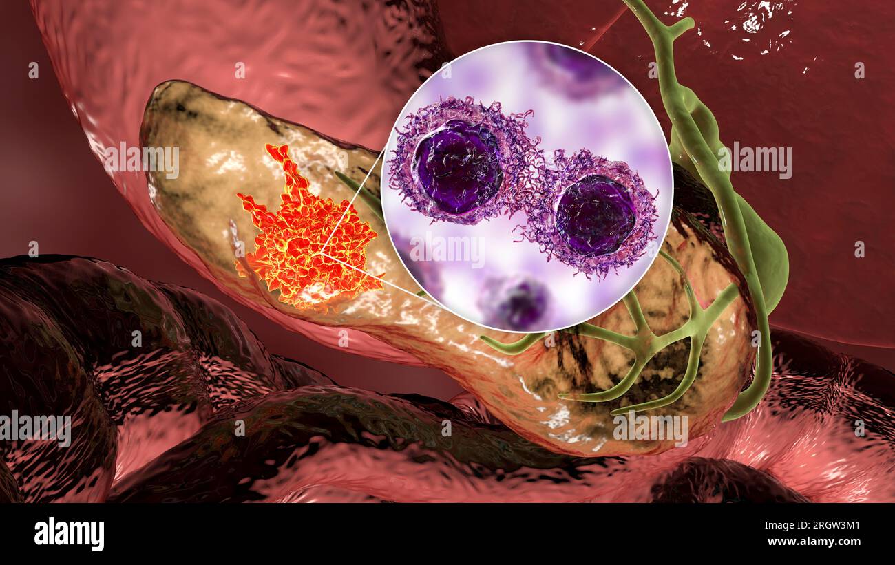 Pancreatic cancer, illustration Stock Photo - Alamy