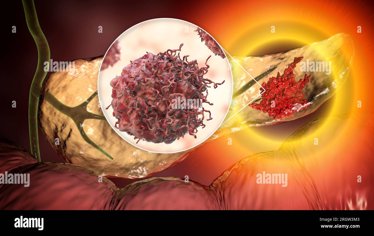 Pancreatic gland hi-res stock photography and images - Alamy